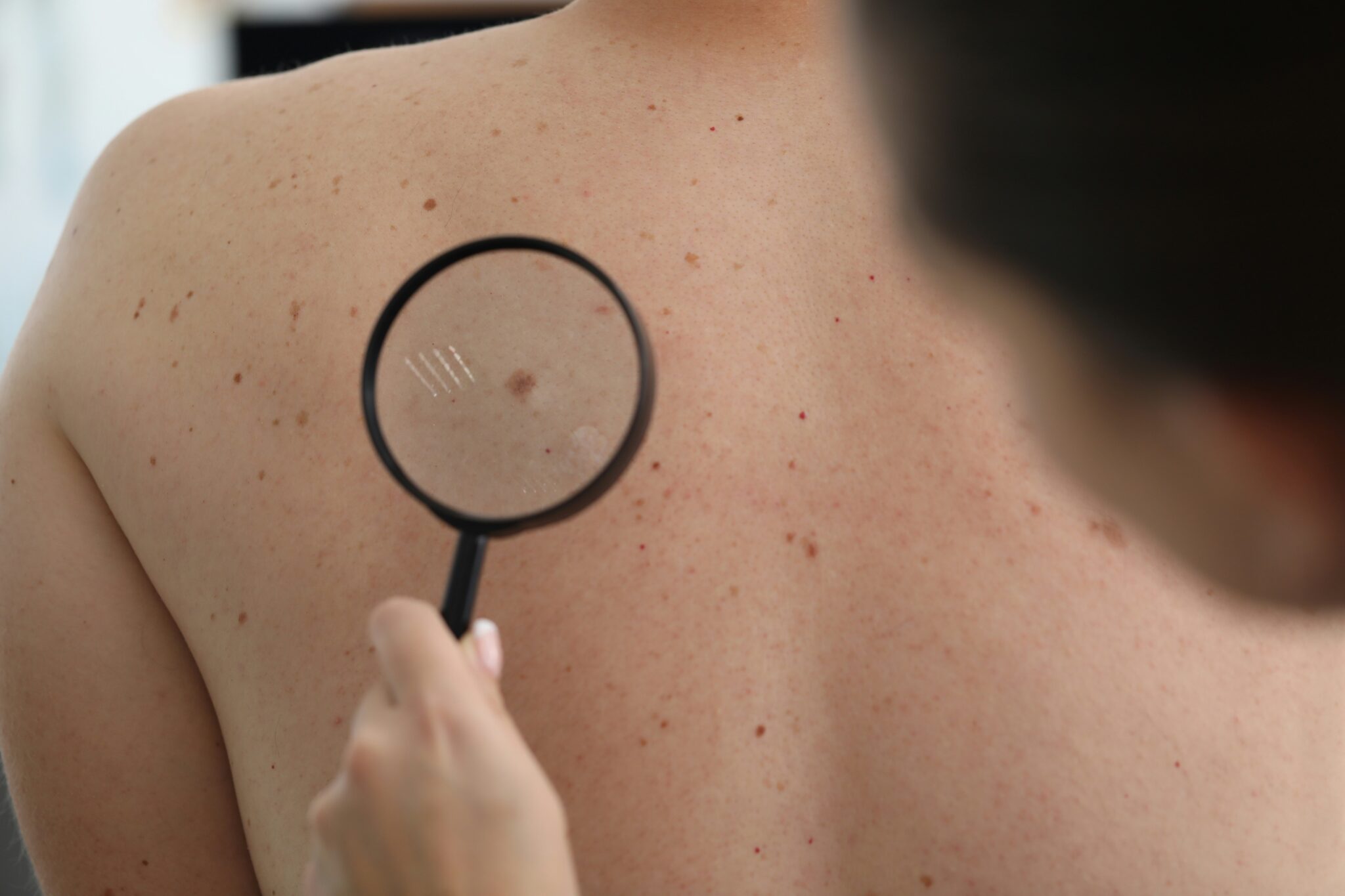 Skin Cancer Survival And Early Detection: What You Need to Know