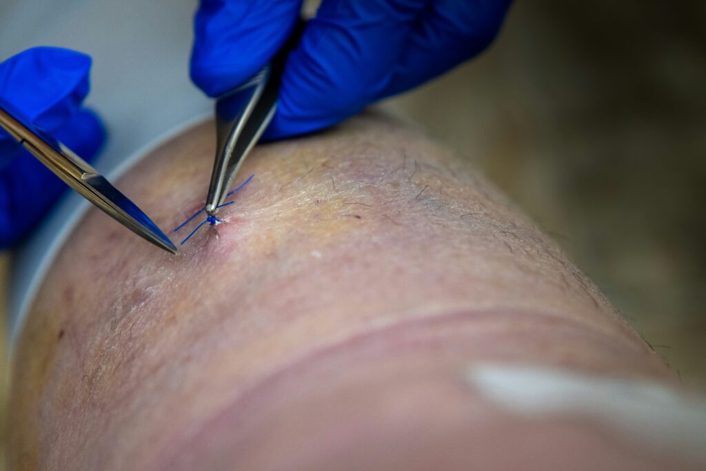 Advanced Dermoscopy Techniques for Skin Cancer